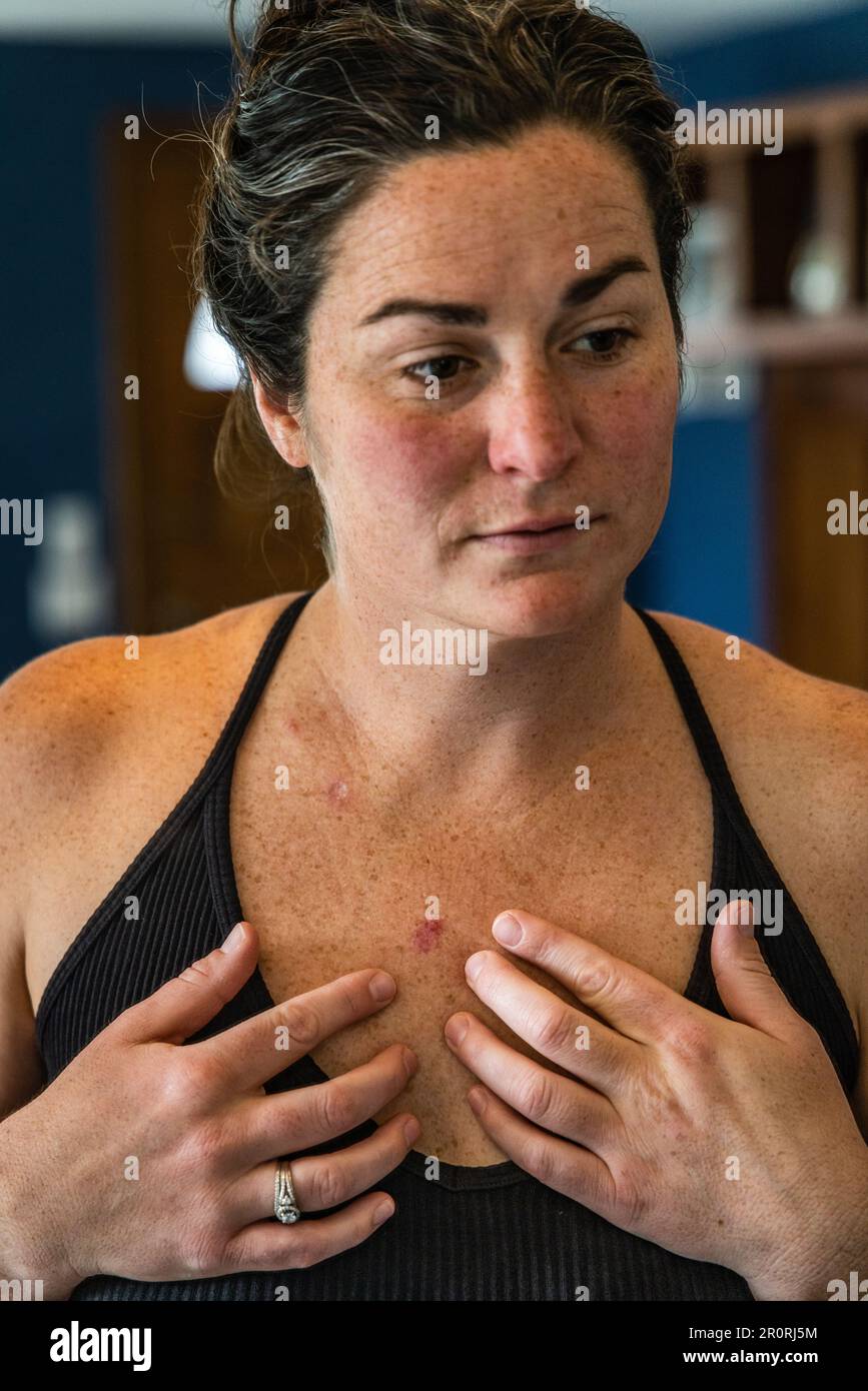 Basal Cell Carcinoma Young at Katie Kendall blog