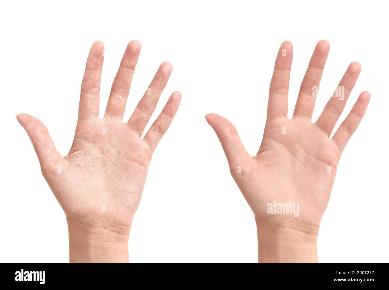 Collage with photos of woman showing hands with dry and moisturized ...