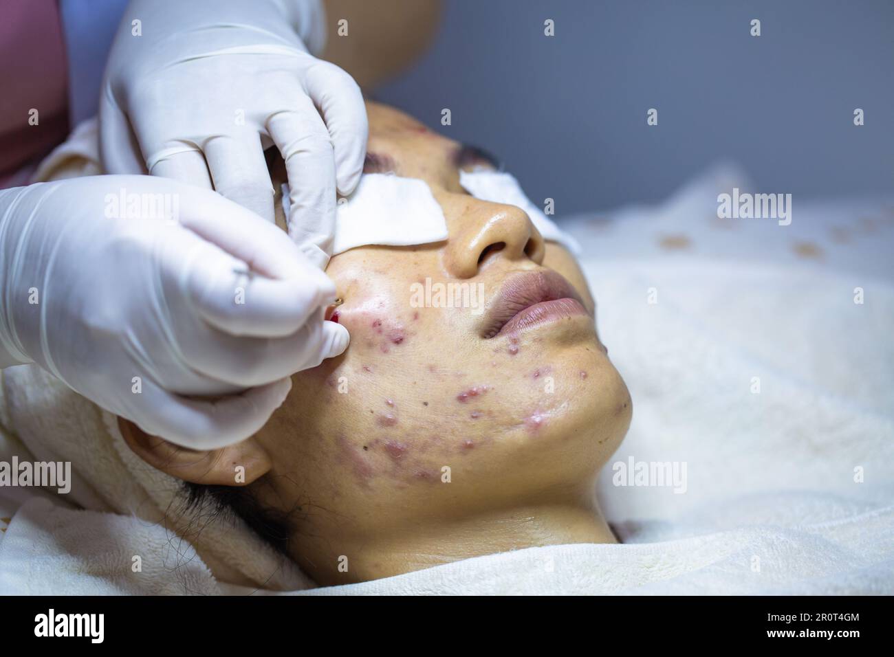 Young woman pressing pimples at the clinic. problems that women worry ...