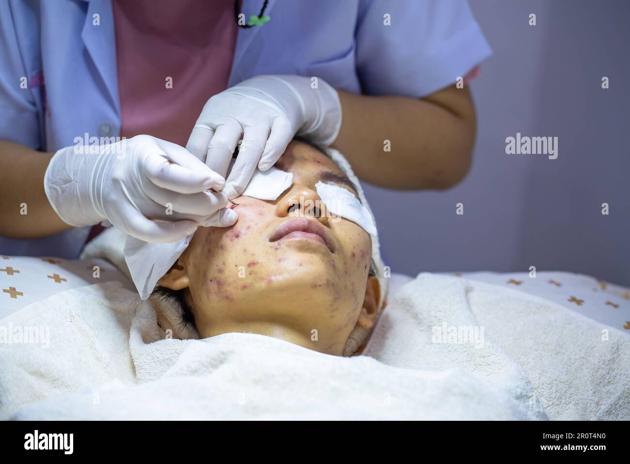 Acne vulgaris hi-res stock photography and images - Alamy