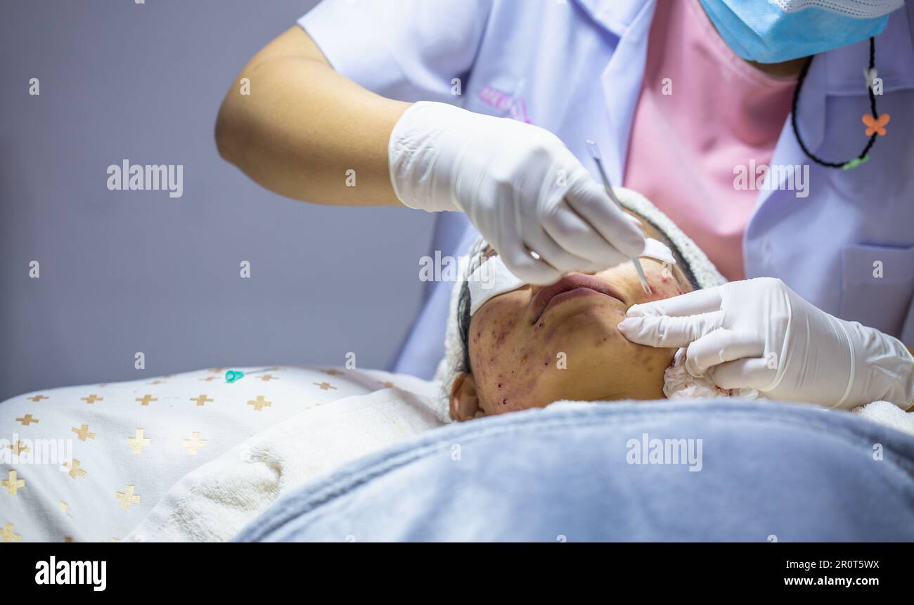 Acne extraction in a beauty clinic. Skin inflammation. The concept of ...