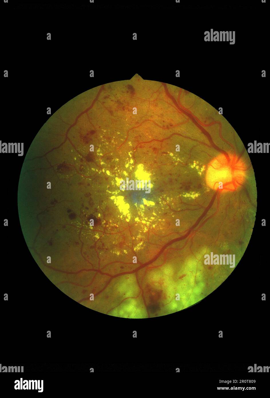 Eye damage due to diabetes, fundoscopy Stock Photo - Alamy