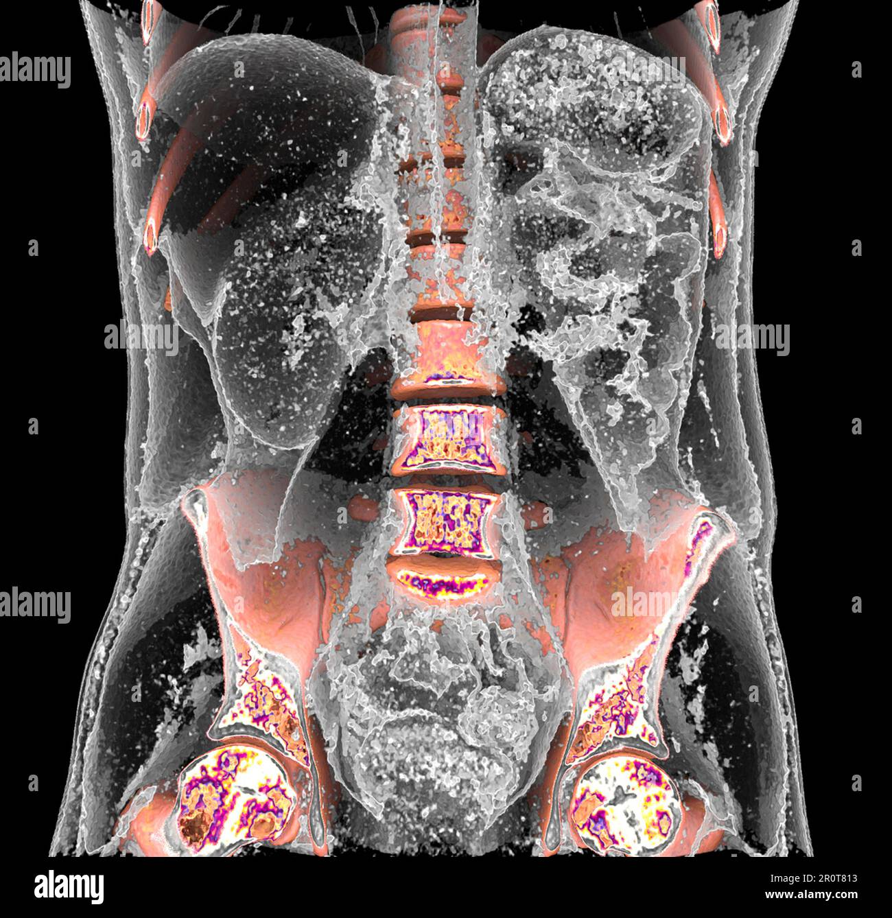 Missing kidney, CT scan Stock Photo - Alamy