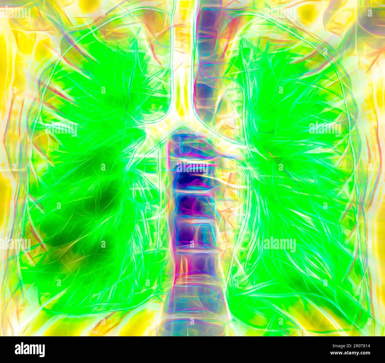 Healthy lungs, CT scan Stock Photo - Alamy