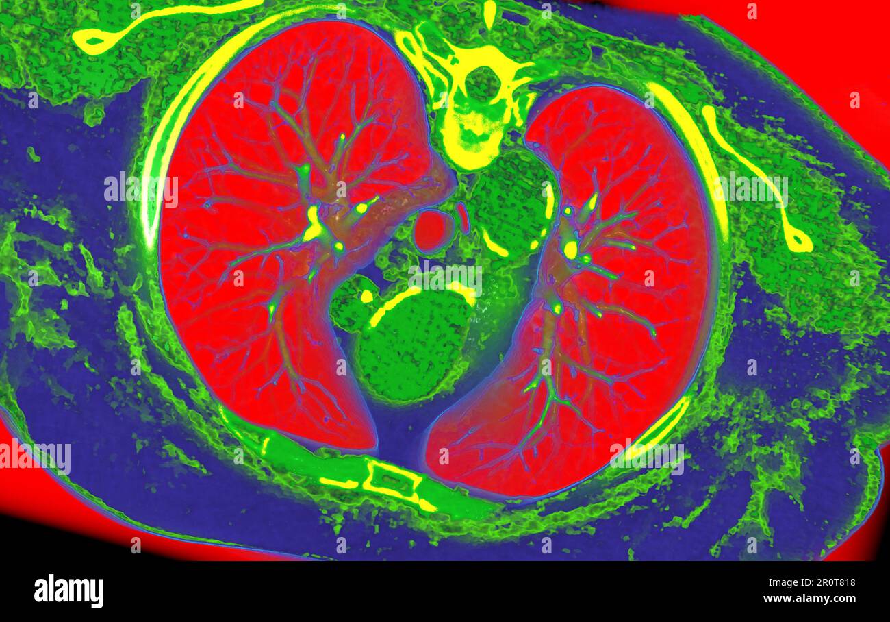 Healthy lungs, CT scan Stock Photo - Alamy