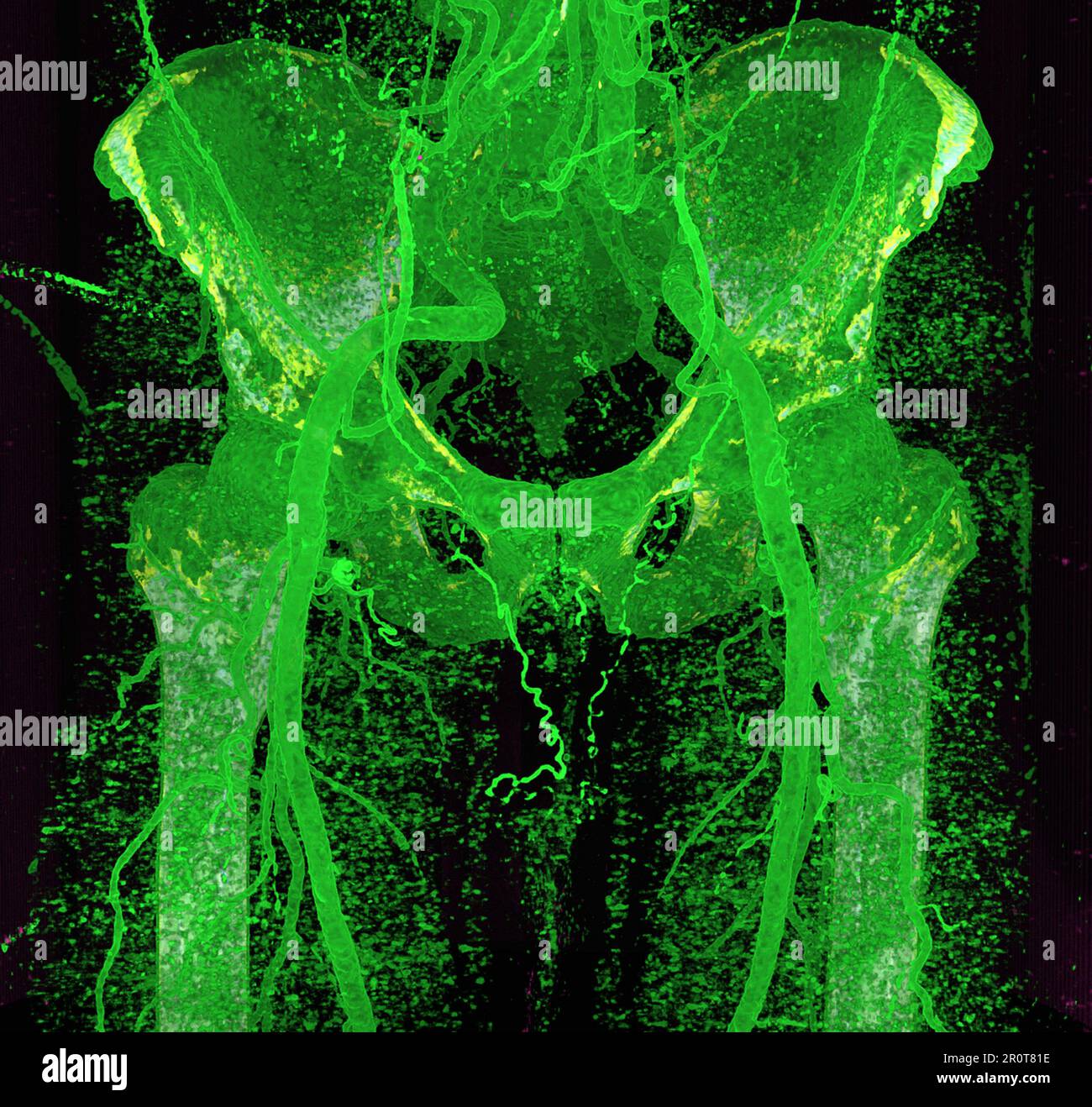 Iliac arteries, CT scan Stock Photo - Alamy