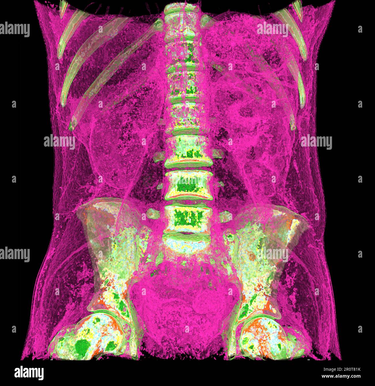 Missing kidney, CT scan Stock Photo - Alamy