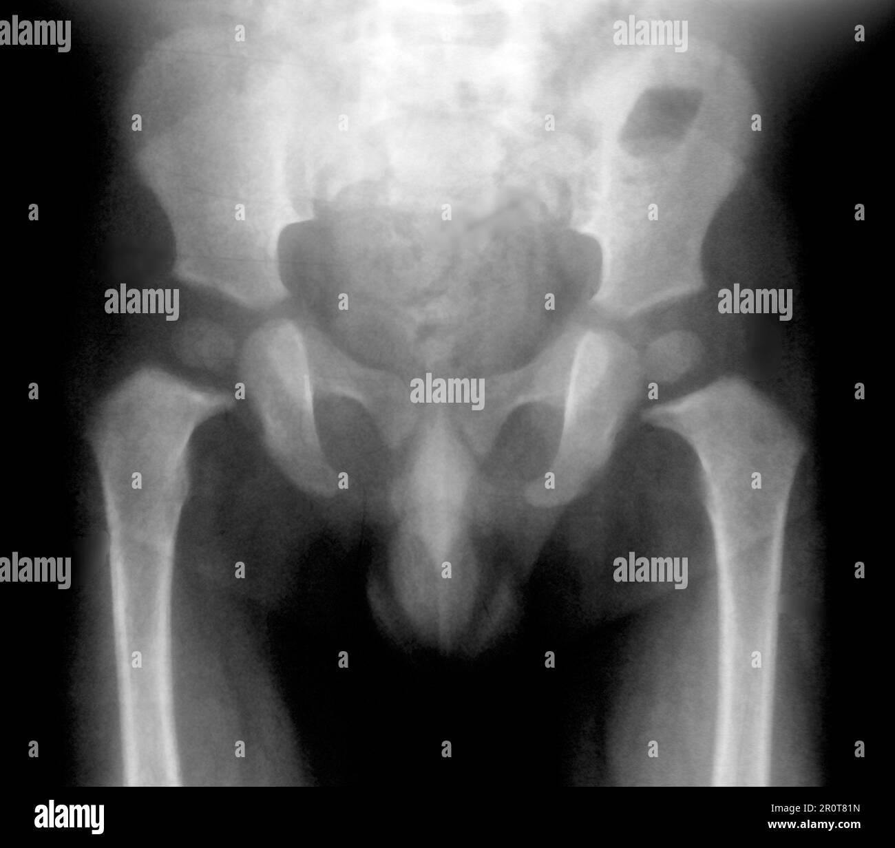 Hip deformity due to rickets, X-ray Stock Photo - Alamy