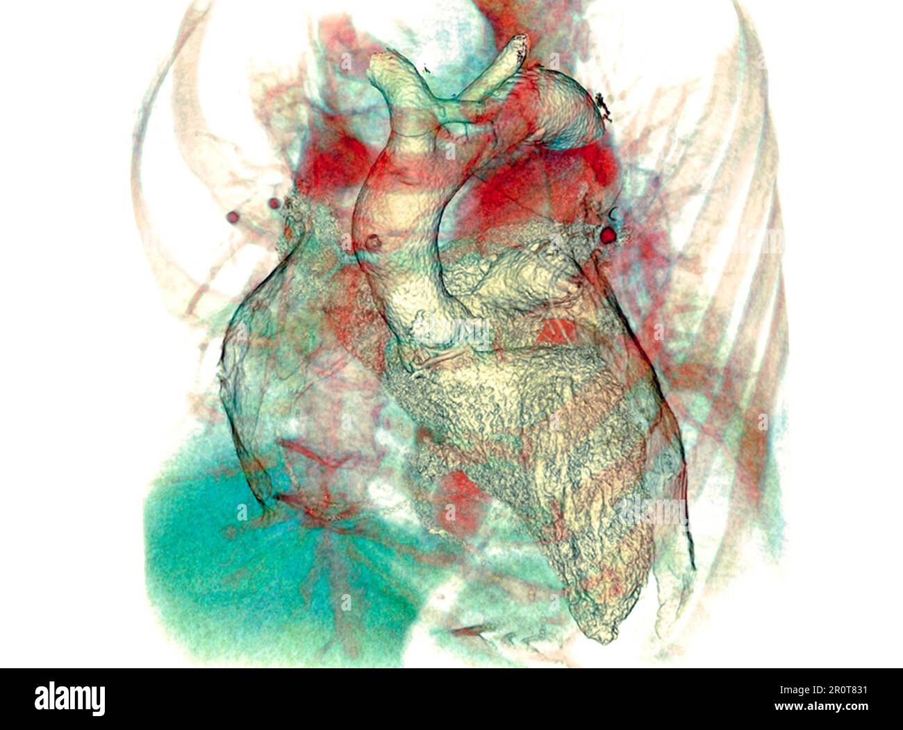 Healthy heart, CT scan Stock Photo - Alamy
