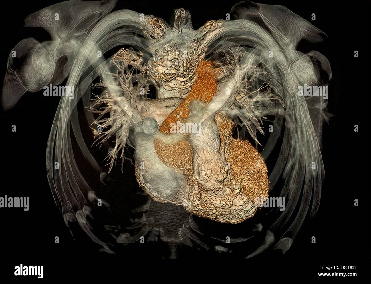Healthy heart, CT scan Stock Photo - Alamy