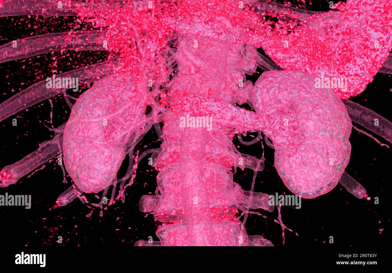 Kidneys, CT scan Stock Photo - Alamy