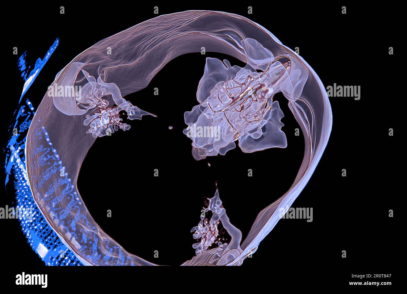 Paranasal sinuses, CT scan Stock Photo - Alamy Paranasal sinuses, CT scan Stock Photo - Alamy