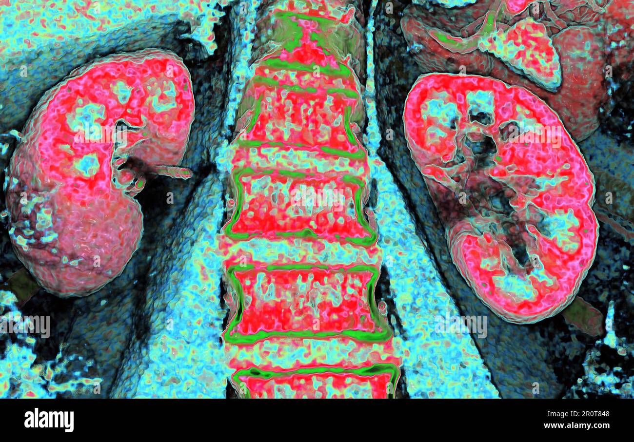 Kidneys, CT scan Stock Photo - Alamy