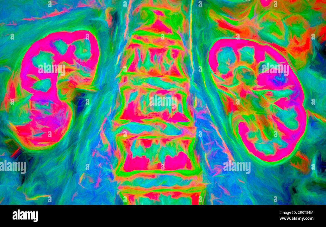 Kidneys, CT scan Stock Photo - Alamy