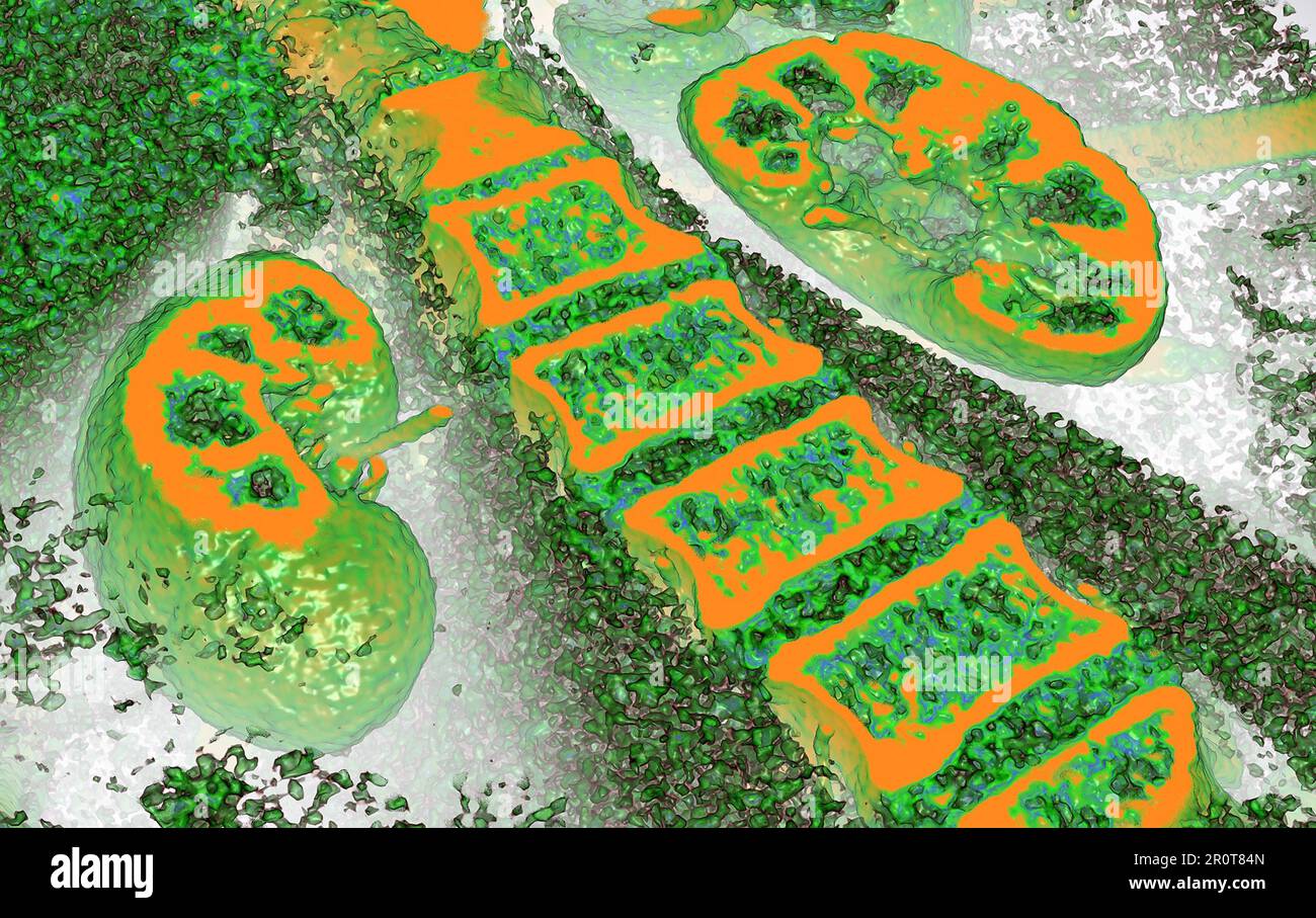 Kidneys, CT scan Stock Photo - Alamy