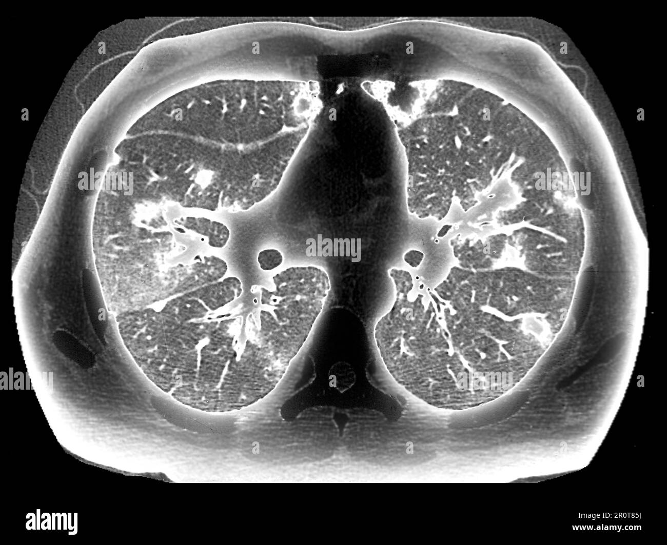 Lung cancer, CT scan Stock Photo - Alamy