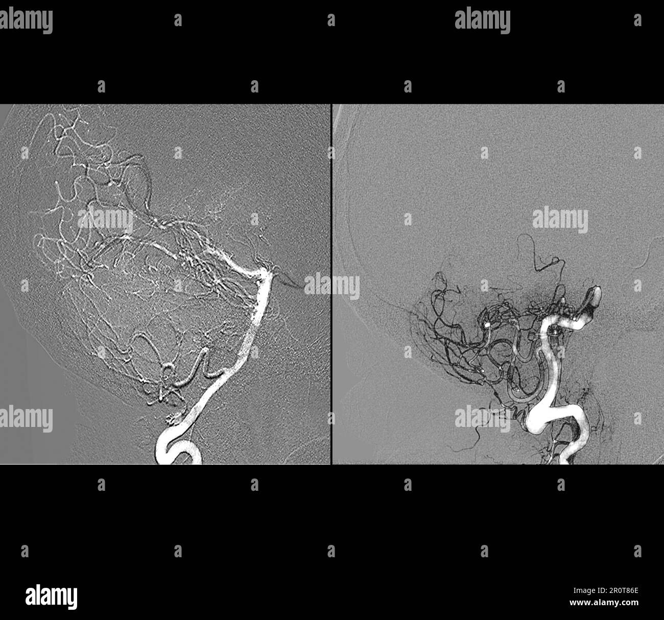 Healthy and blocked artery, CT scans Stock Photo - Alamy