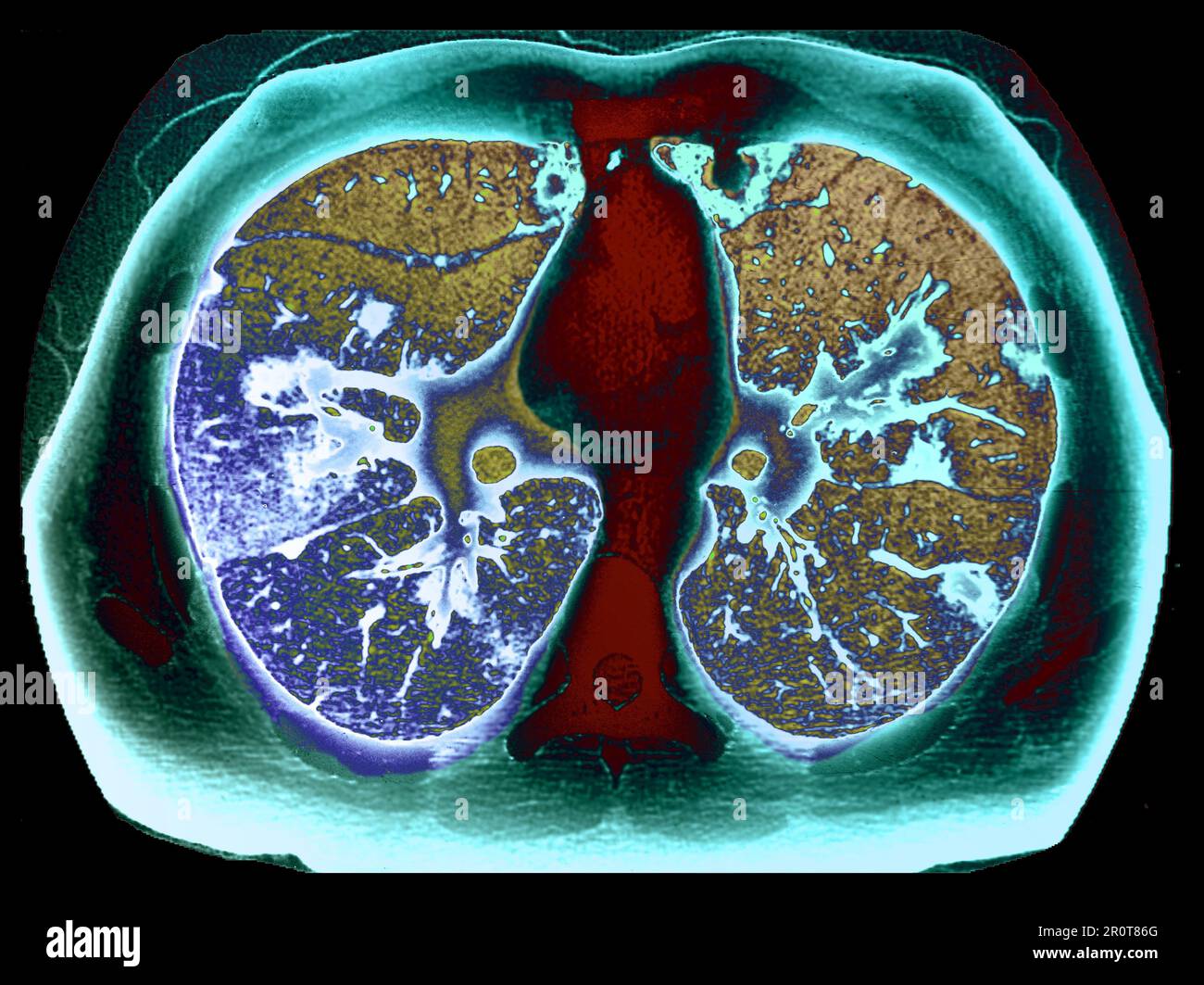 Lung cancer, CT scan Stock Photo - Alamy
