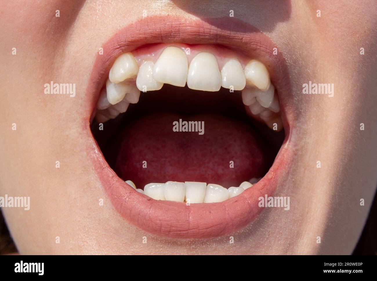 Curved female teeth, before installing braces. Close - up of teeth ...
