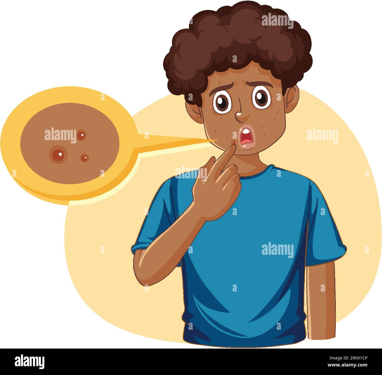 Teenage Boy with Acne Troubles illustration Stock Vector Image & Art ...