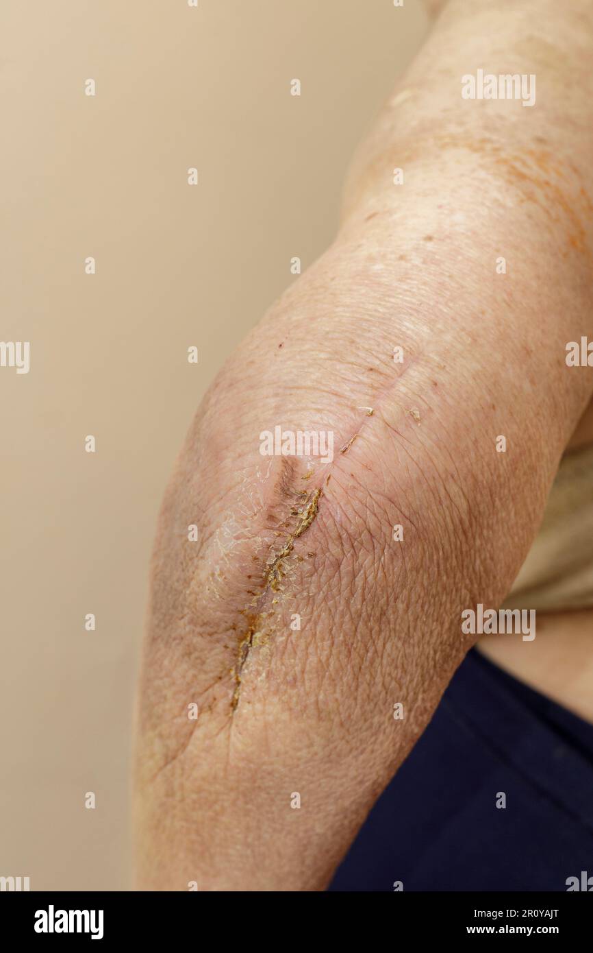 Older woman who suffered a fall that caused her elbow fracture and has ...