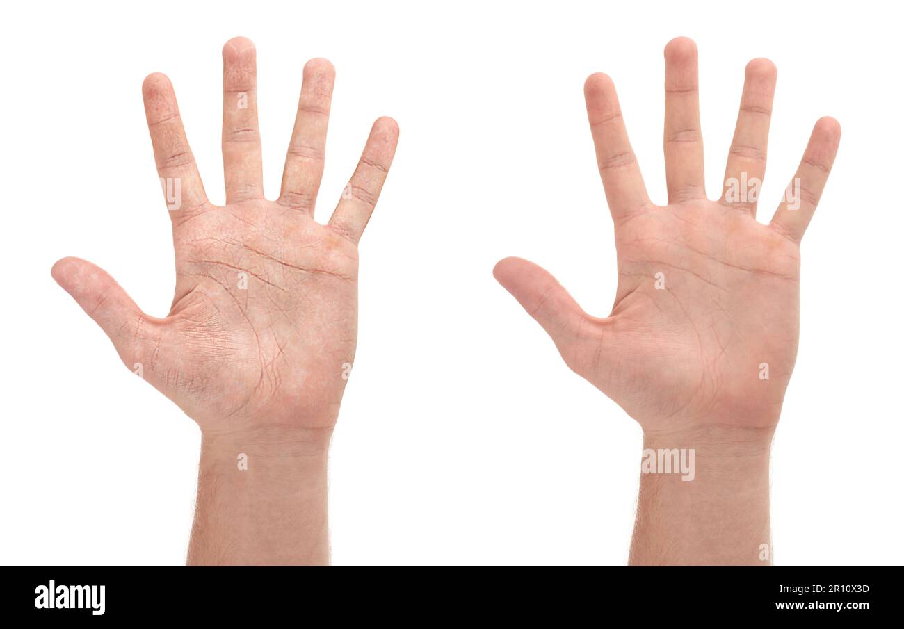 Collage with photos of man showing hands with dry and moisturized skin ...