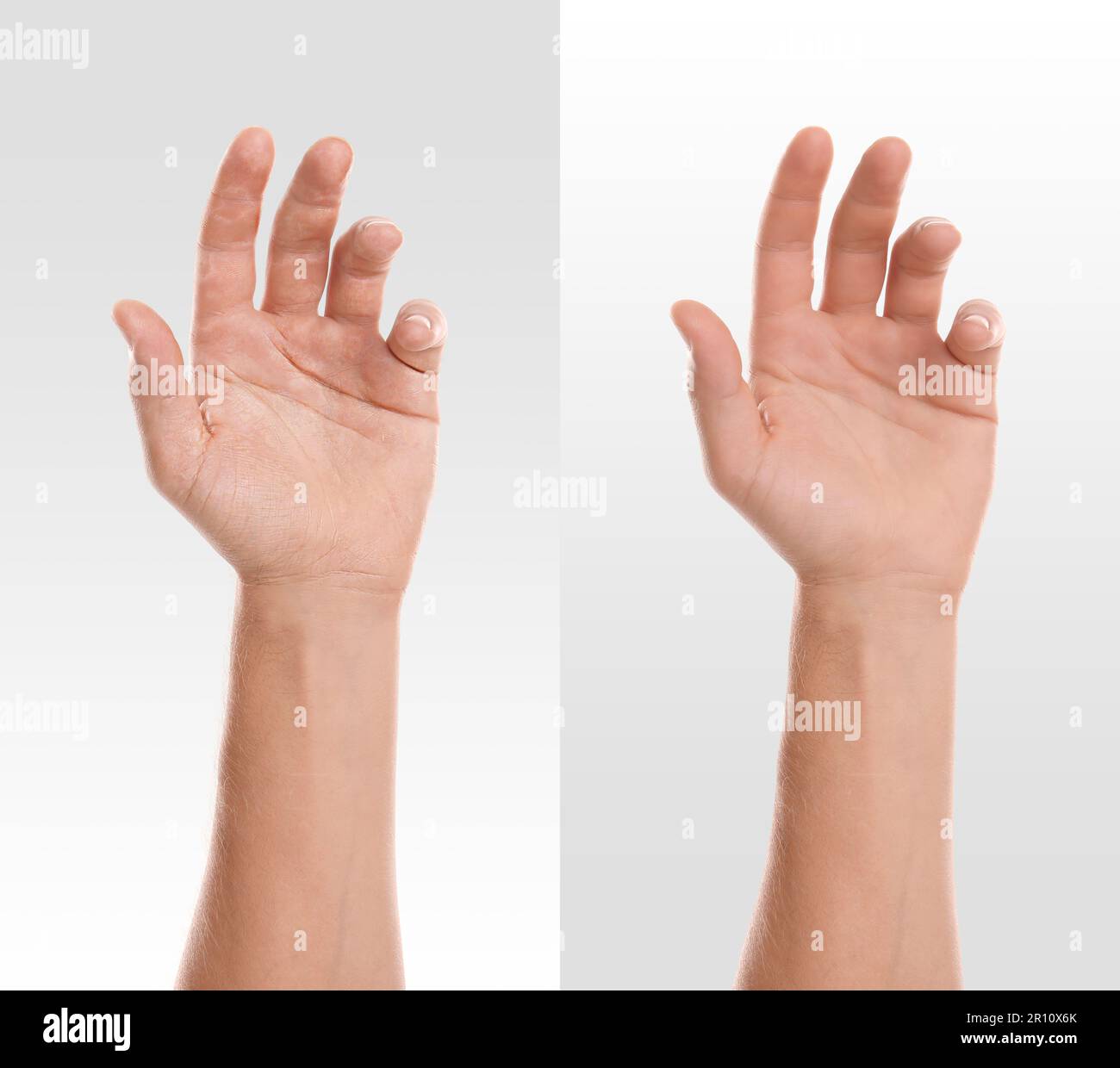 Collage with photos of man showing hands with dry and moisturized skin ...