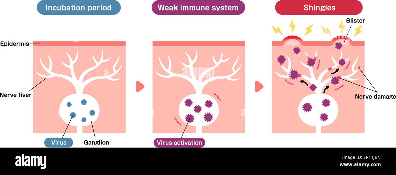 Mechanism of shingles ( herpes zoster ) vector illustration Stock ...