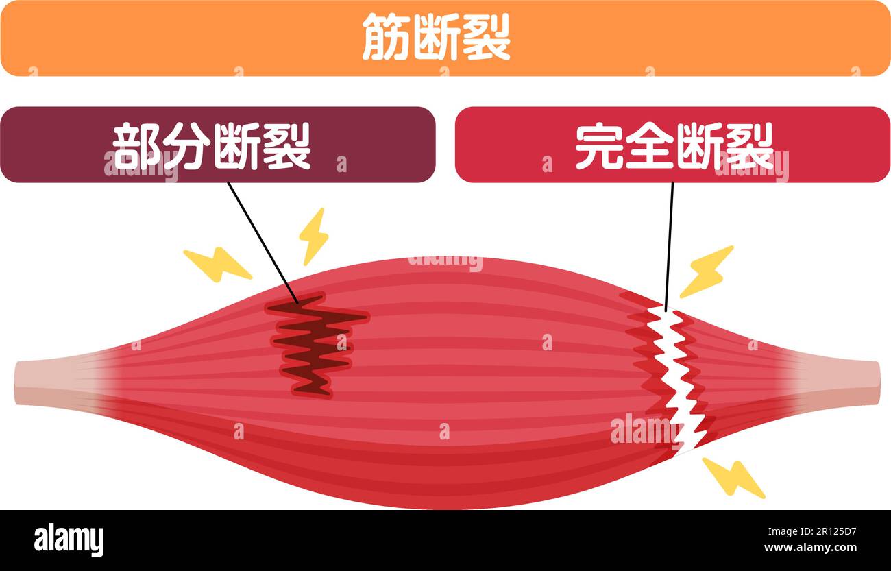 Muscle rupture vector illustration (partial and complete tears Stock ...