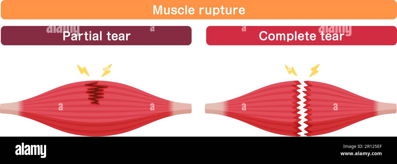 Muscle rupture vector illustration (partial and complete tears Stock ...