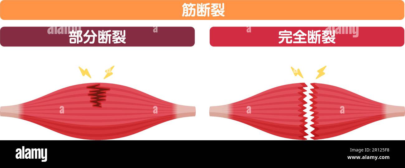 Muscle rupture vector illustration (partial and complete tears Stock ...