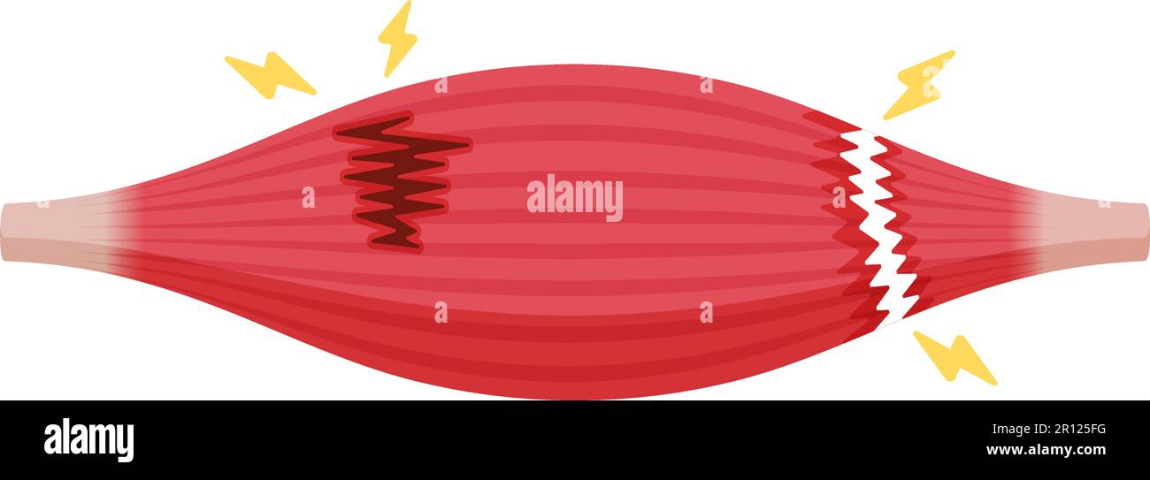 Muscle rupture vector illustration (partial and complete tears Stock ...