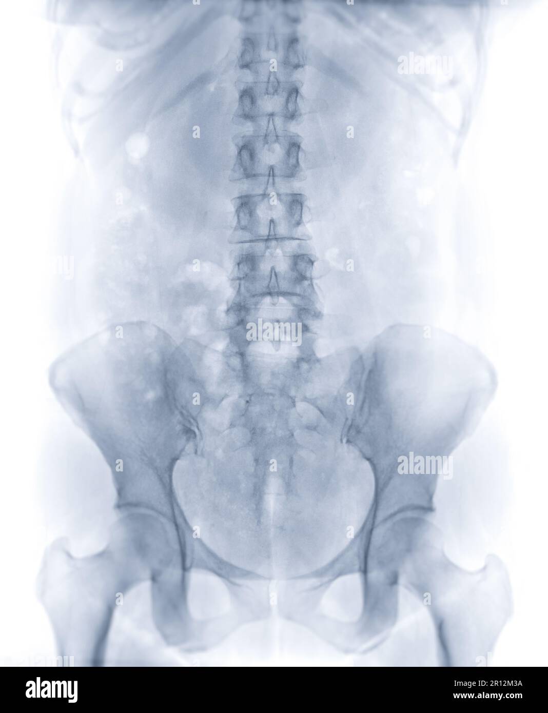 Plain Abdomen or plain kub is x-ray image of human abdominal part Stock ...