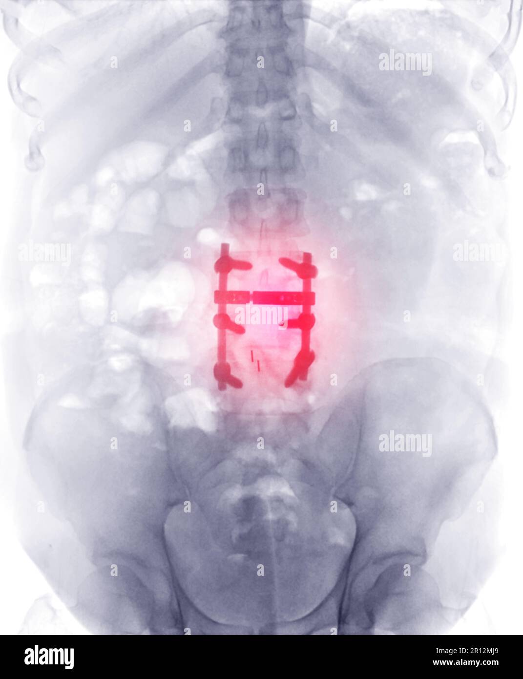 X-ray image of lumbar Spine or L-s spine Post operative Fix Lumbar ...