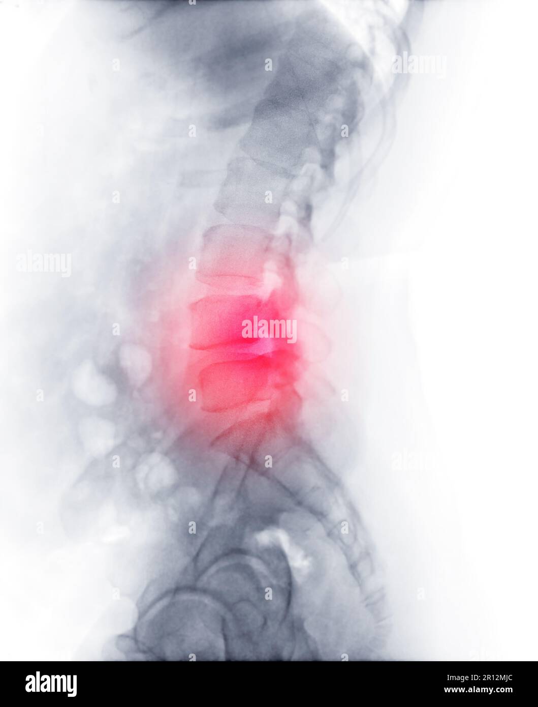 X-ray image of lumbar Spine or L-s spine Post operative Fix Lumbar ...