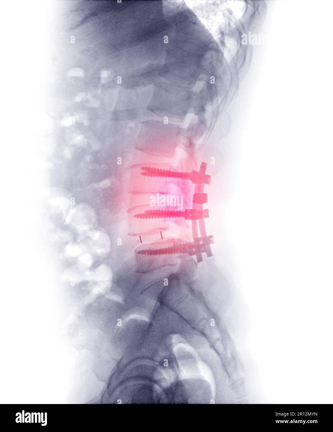 X-ray image of lumbar Spine or L-s spine Post operative Fix Lumbar ...