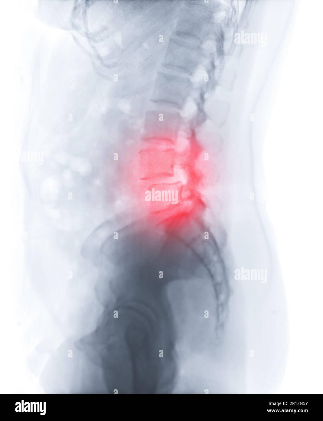 X-ray image of lumbar Spine or L-s spine lateral view for diagnosis ...