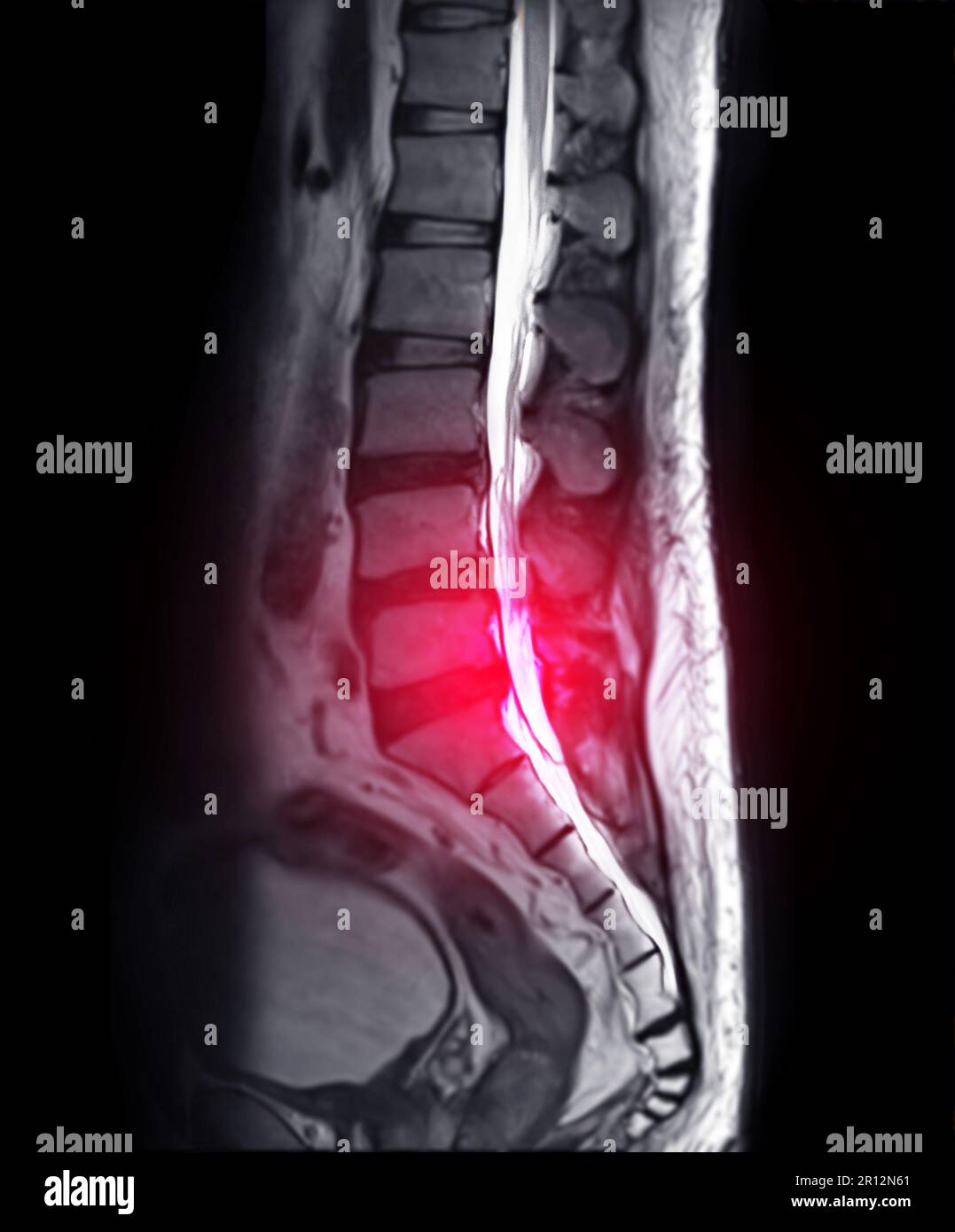 Spinal Cord Compression