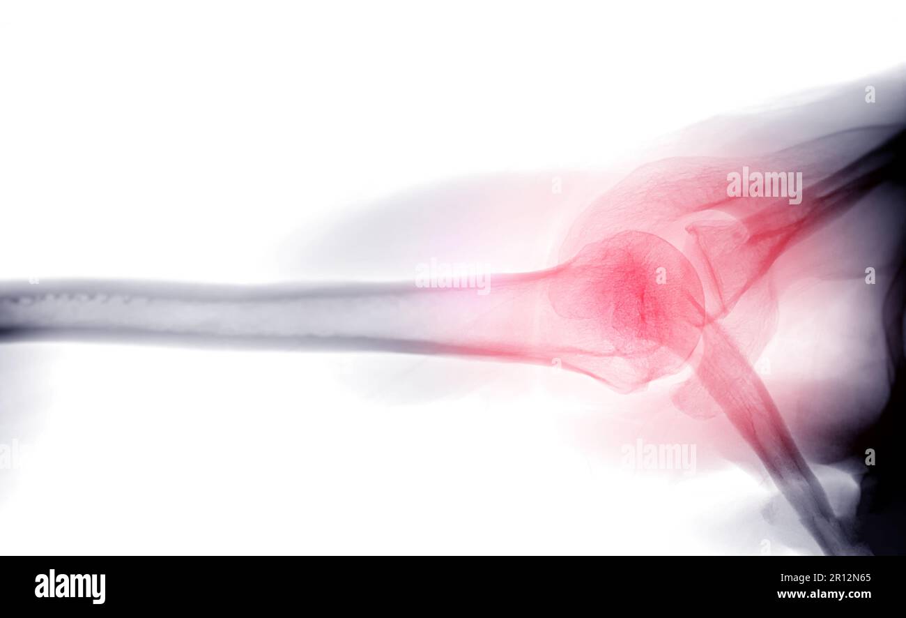 X-ray Shoulder joint shoulder transaxillary view for diagnosis fracture ...