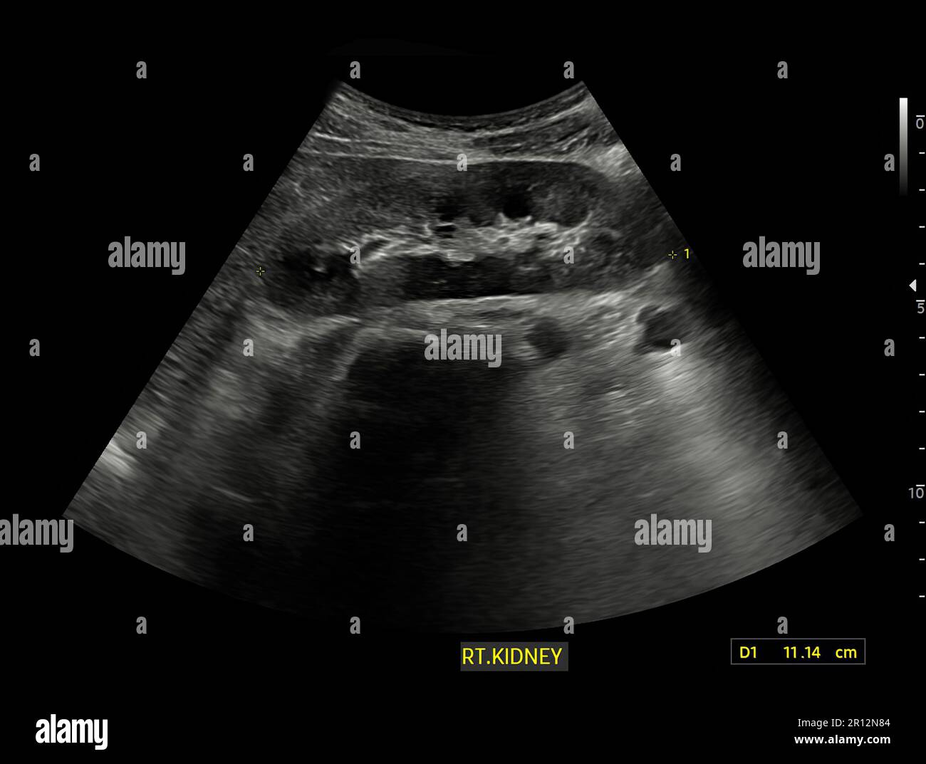 Ultrasound of Kidney or KUB for screening renal stone disease or ...