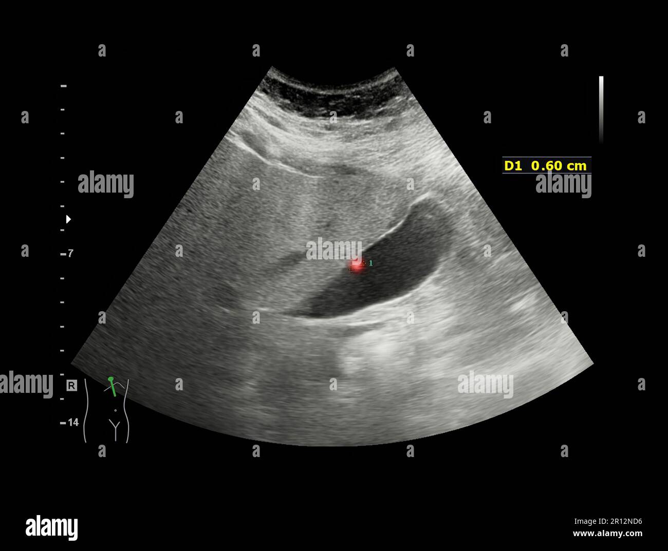 Ultrasound upper abdomen for diagnosis abdominal pain Stock Photo - Alamy
