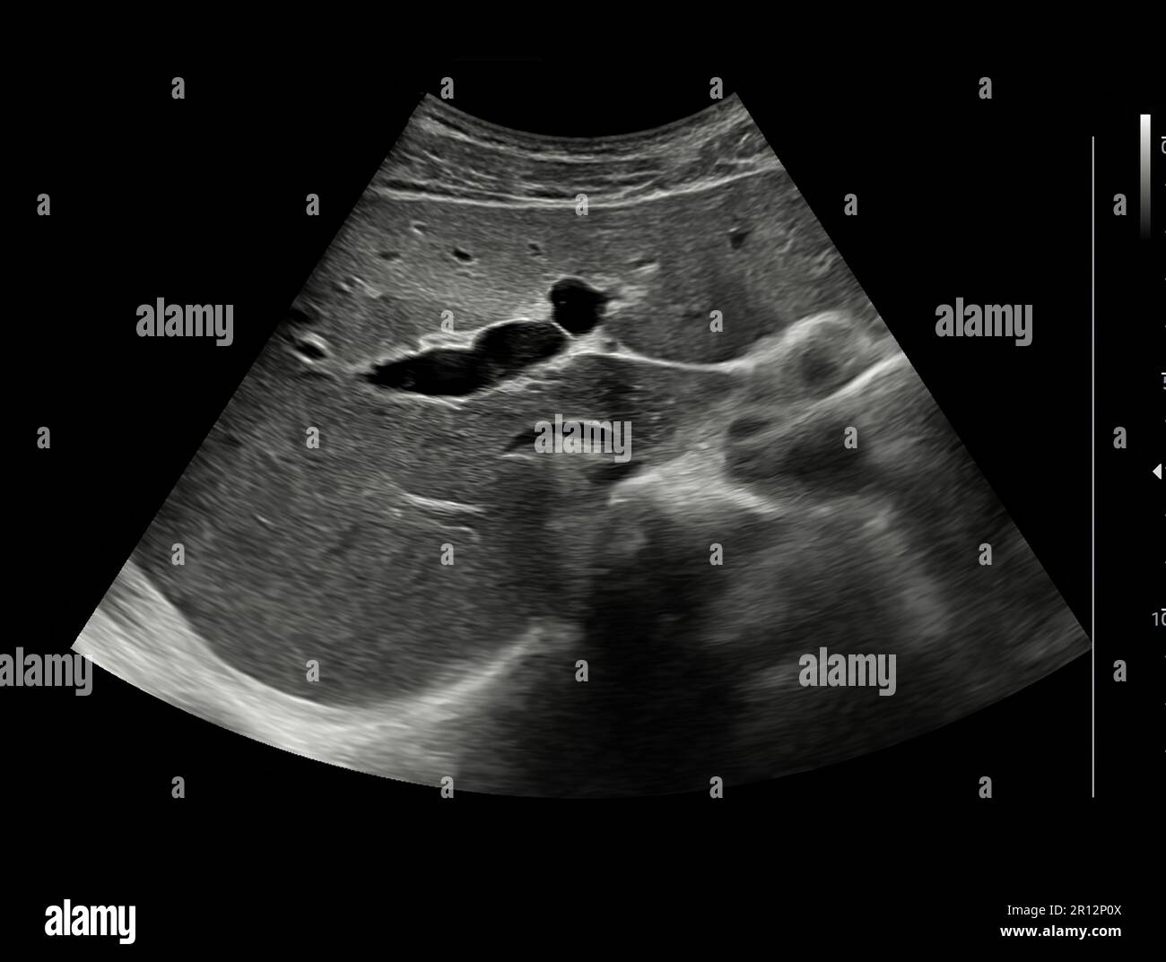 Ultrasound upper abdomen for diagnosis abdominal pain Stock Photo - Alamy