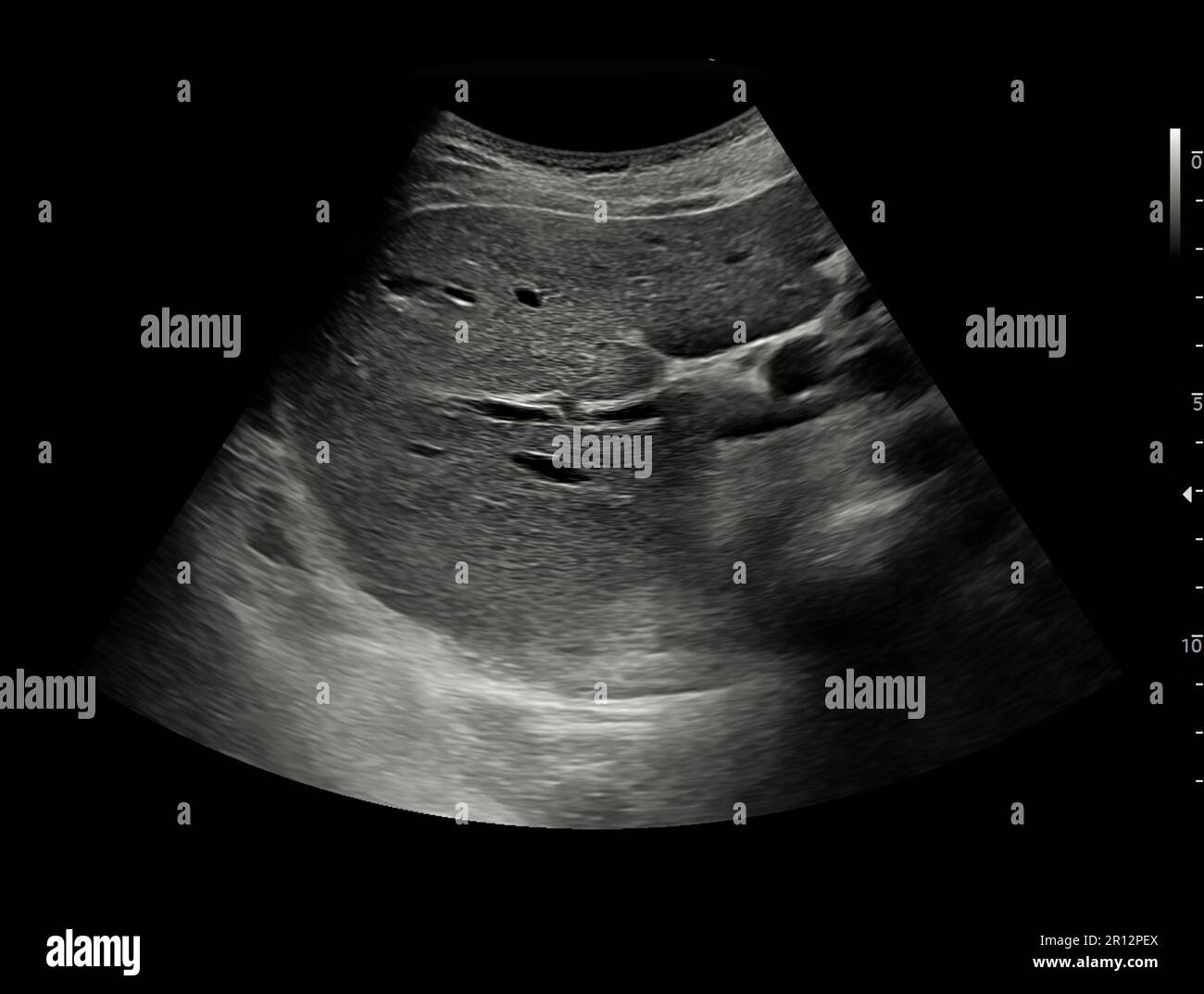 Ultrasound upper abdomen for diagnosis abdominal pain Stock Photo - Alamy