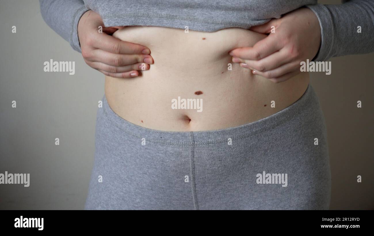 Young overweight or plus size woman with fat big belly, surgery and fat ...