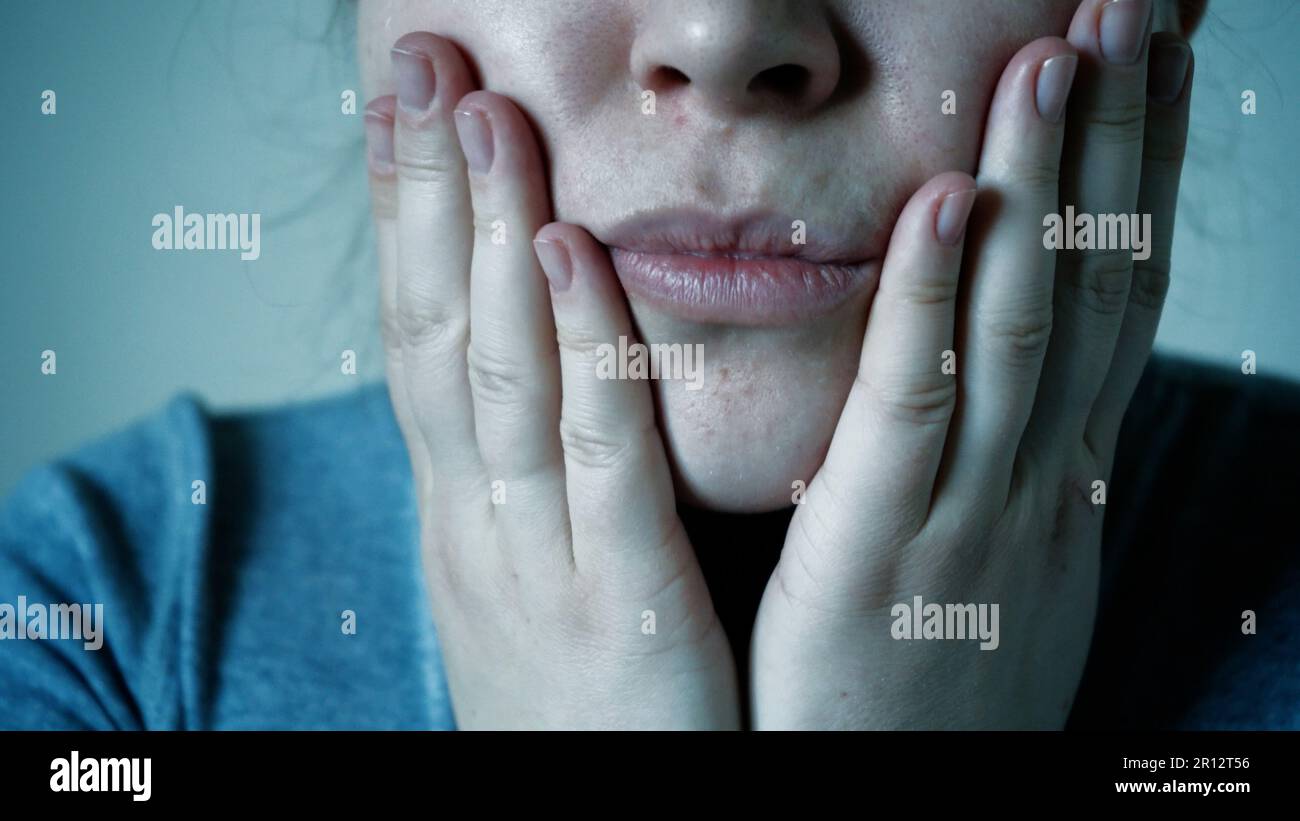 Close up of skin problems, unhealthy skin with acne and pimples. Porous ...