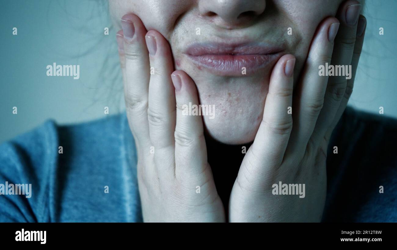 Close up of skin problems, unhealthy skin with acne and pimples. Porous ...