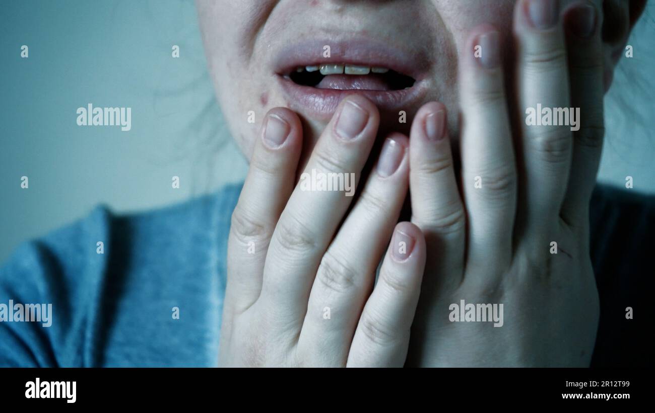 Close up of skin problems, unhealthy skin with acne and pimples. Porous ...