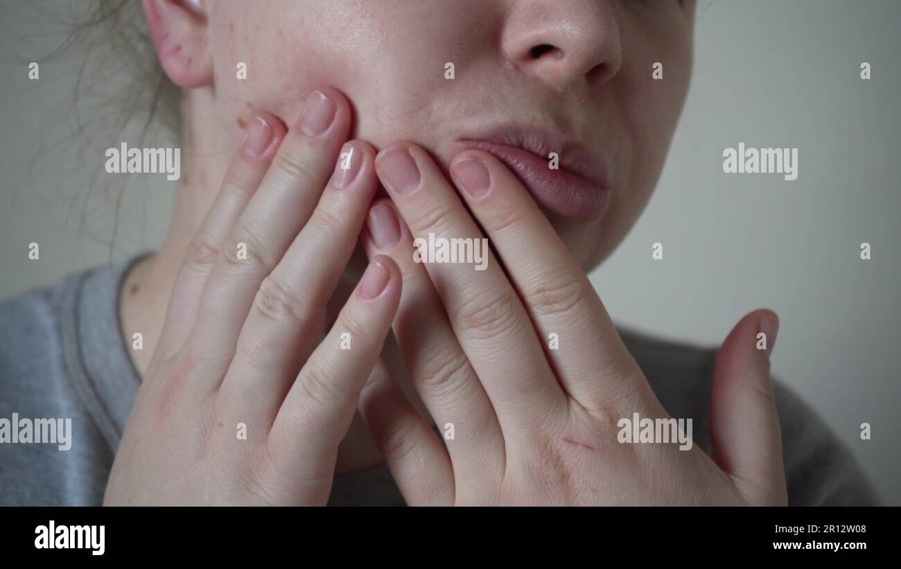 Close up of skin problems, unhealthy skin with acne and pimples. Porous ...