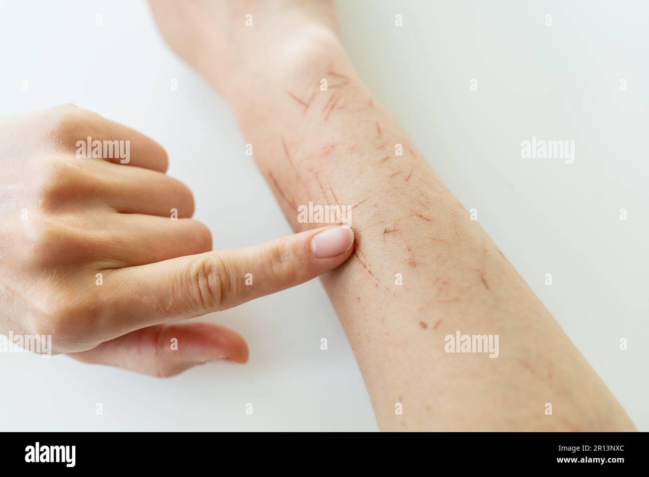 The doctor examines the hand, the person is scratched all over, dry ...