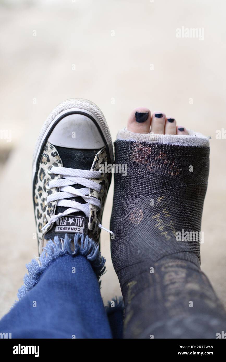 Broken Leg versus Converse shoe Stock Photo - Alamy